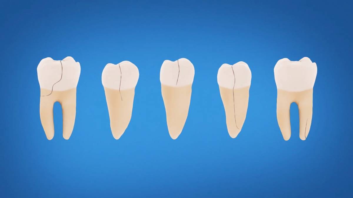 5 Facts About Tooth Fractures You Need to Know About - LIFESTYLE ...
